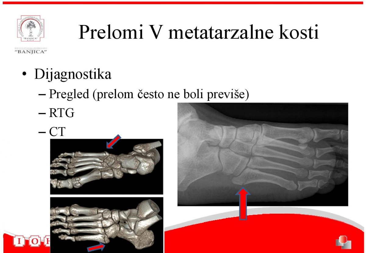 VIRUSNO OBOLJENJE SRCA, NESTABILNOST ČAŠICE I POVREDA STOPALA ...